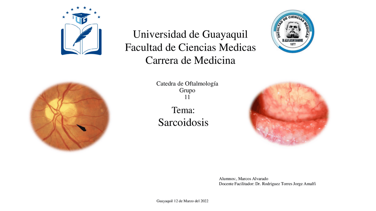 La Sarcoidosis Y Su Funciones Diapositivas De Oftalmología Docsity