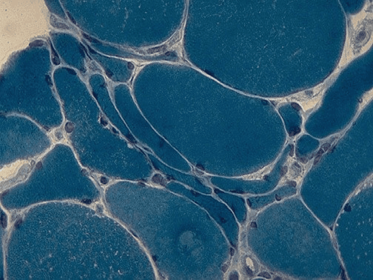 Atrofias y hipertrofias | Diapositivas de Patología | Docsity