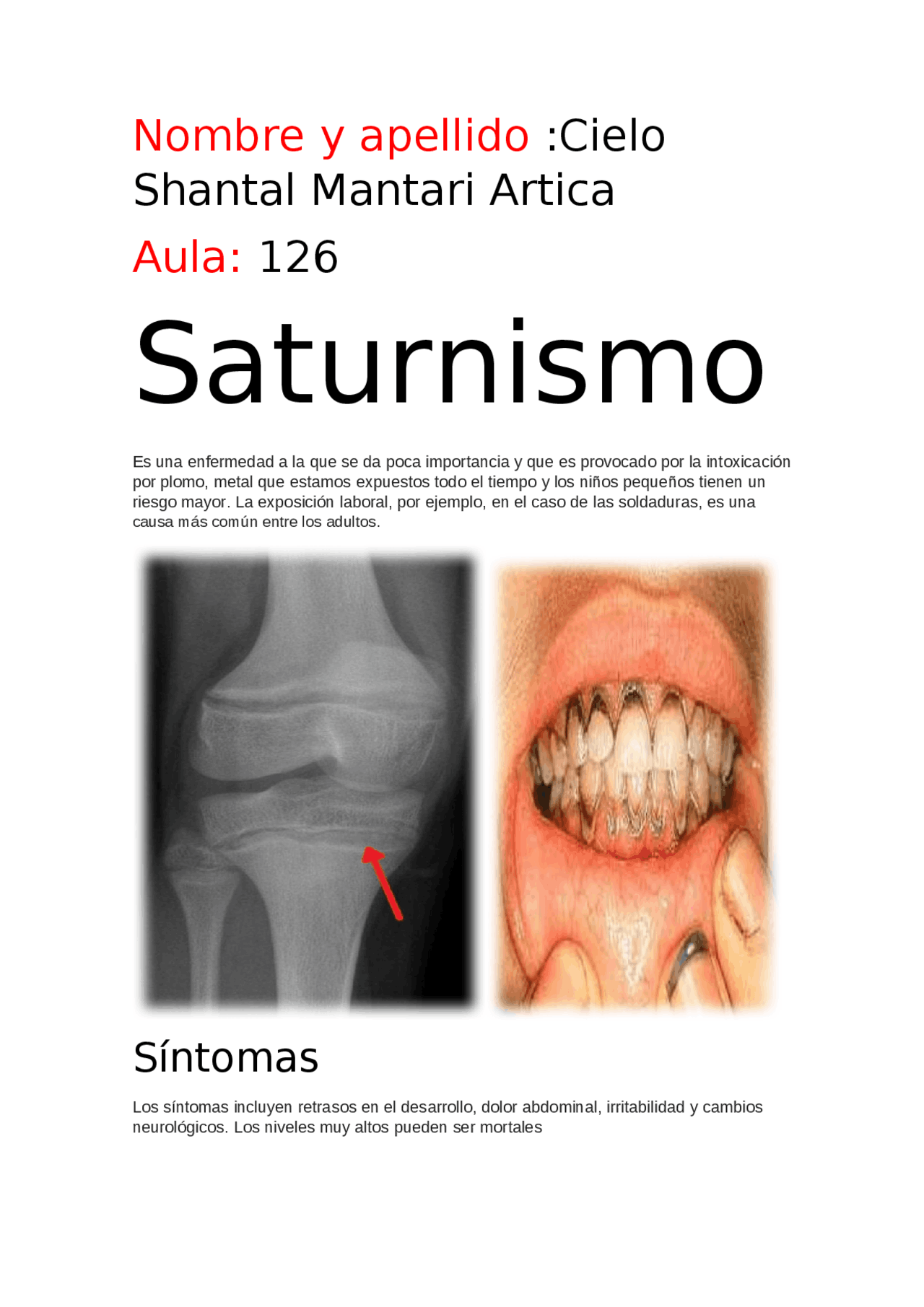 Intoxicación por metales pesados: Saturnismo y Enfermedad de Minamata ...