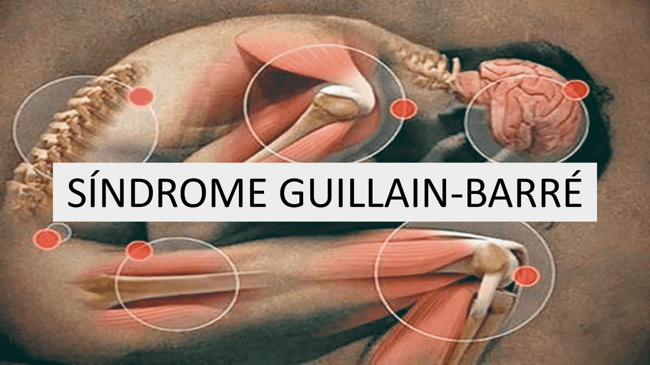 SÍNDROME GUILLAIN-BARRÉ | Slides Fisiopatologia | Docsity