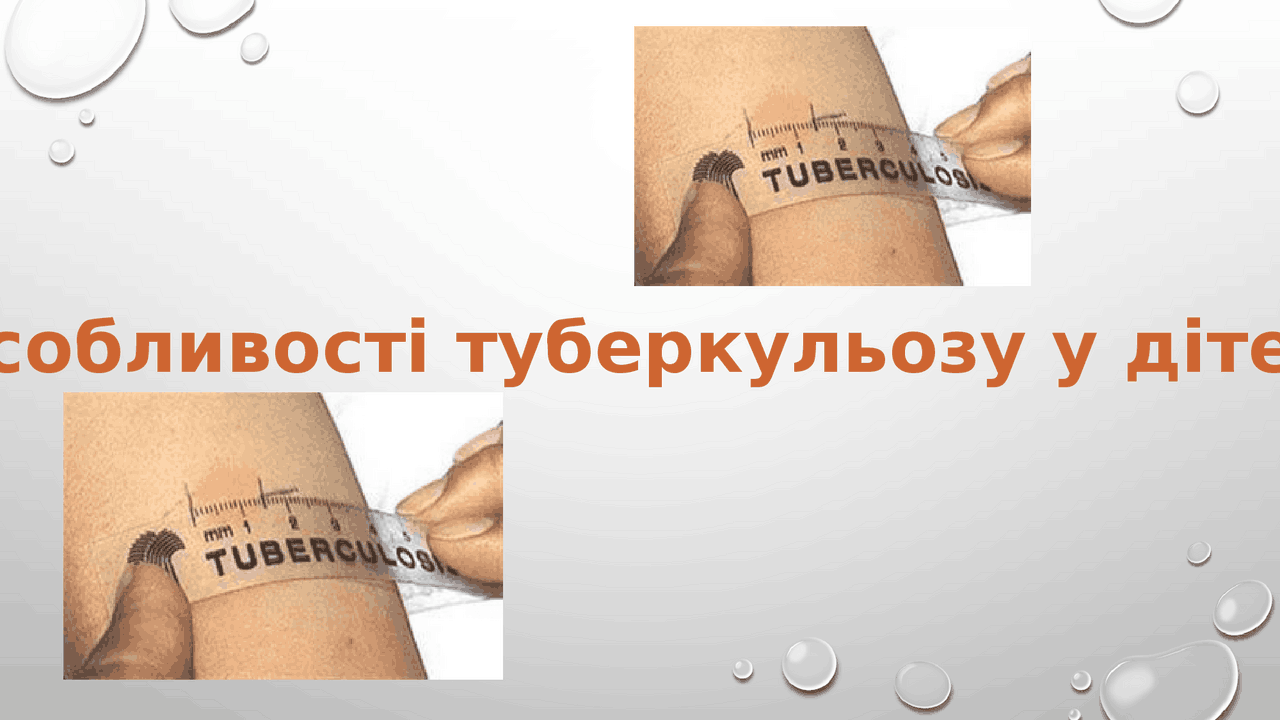 презентація на тему туберкульоз у дітей Презентации Педиатрия Docsity