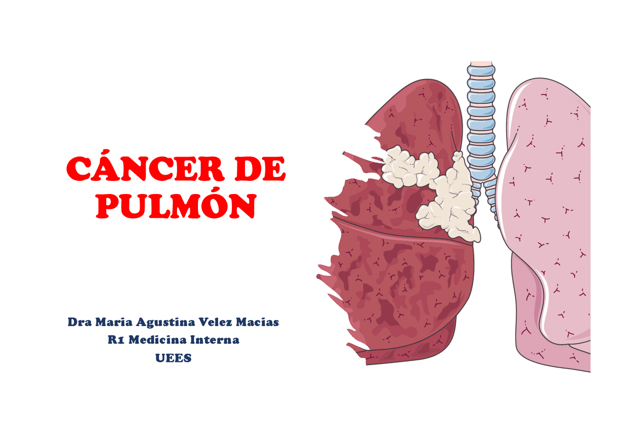 Cancer de Pulmon definición , tratamiento | Diapositivas de Neumología ...