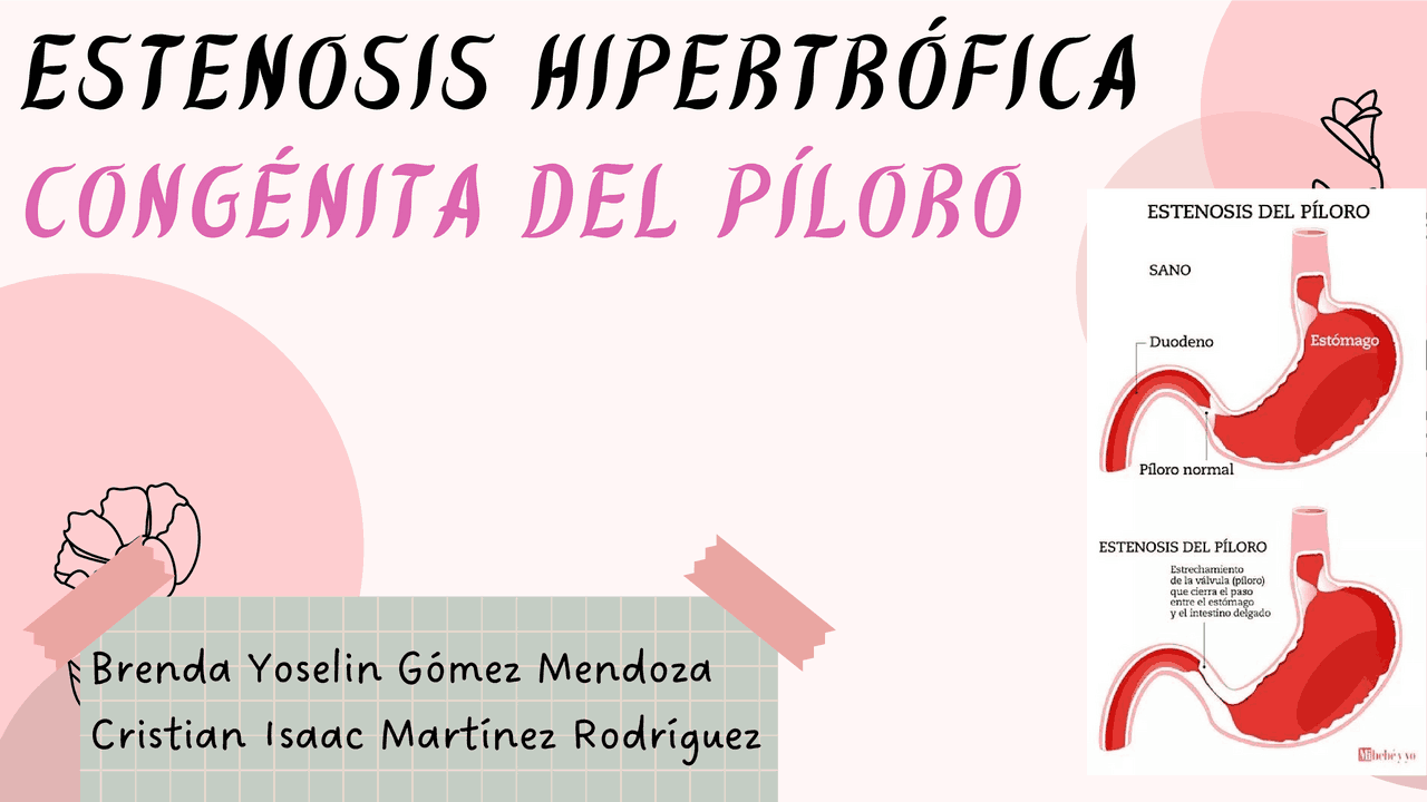 Estenosis Hipertrófica Congénita de Píloro | Diapositivas de Pediatría ...