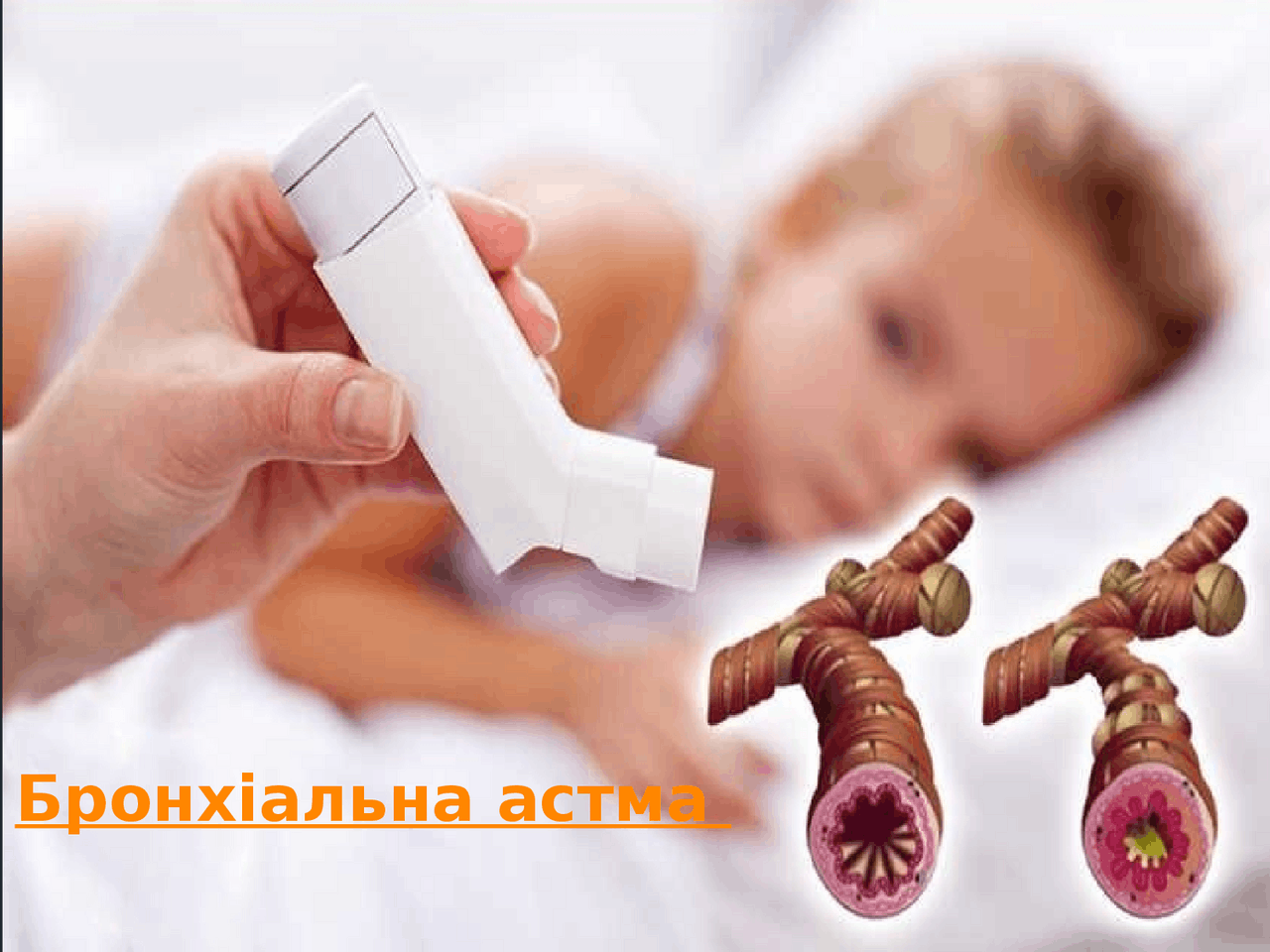 Бронхіальна астма у дітей Презентации Терапия Docsity