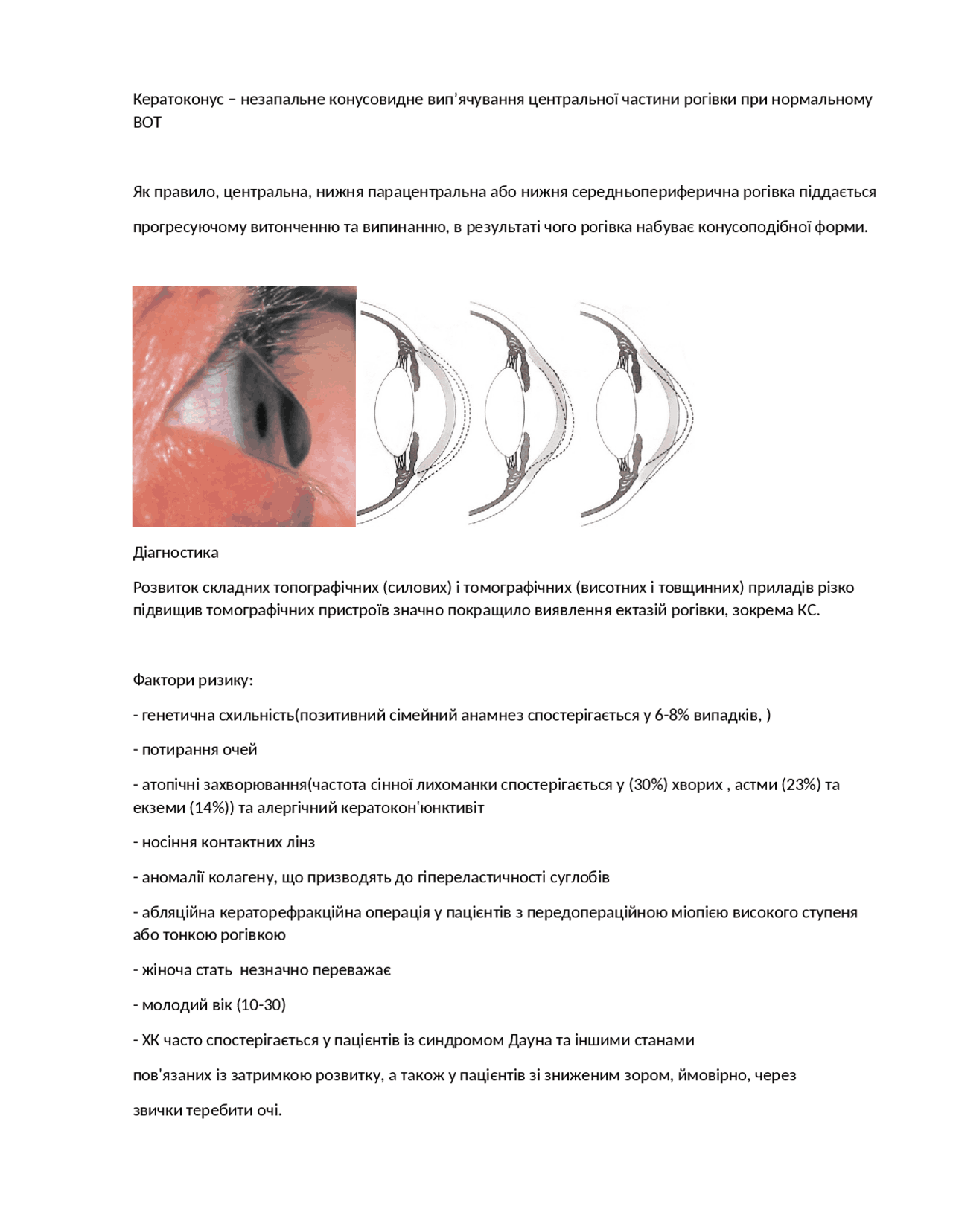 Конспект на тему кератоконус Шпаргалки Офтальмология Docsity