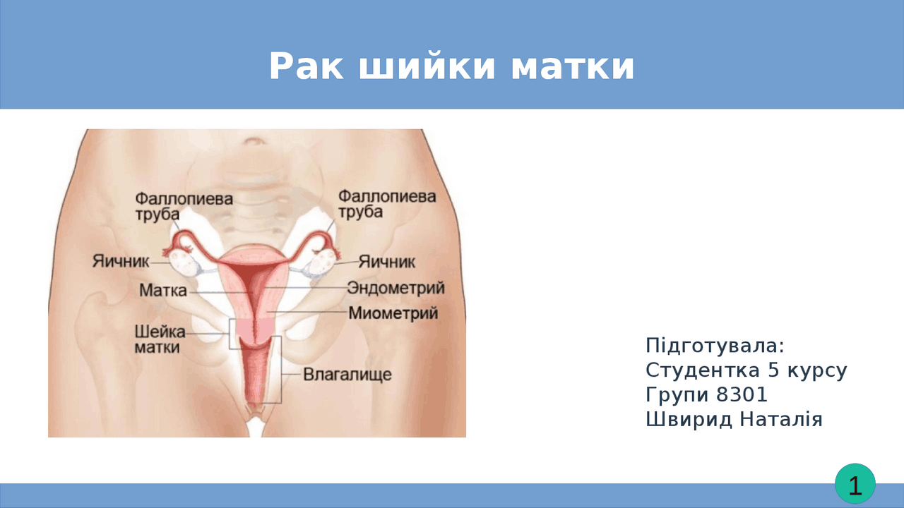 Рак шийки матки презентація Схемы Онкология Docsity
