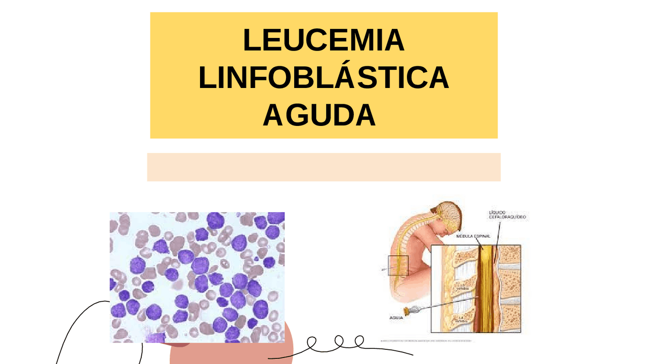 LEUCEMIA LINFOBLASTICA AGUDA | Diapositivas de Medicina | Docsity