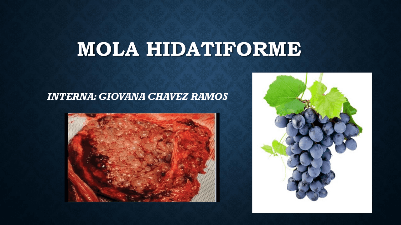 MOLA HIDATIFORME GINECOLOGIA | Diapositivas de Medicina | Docsity
