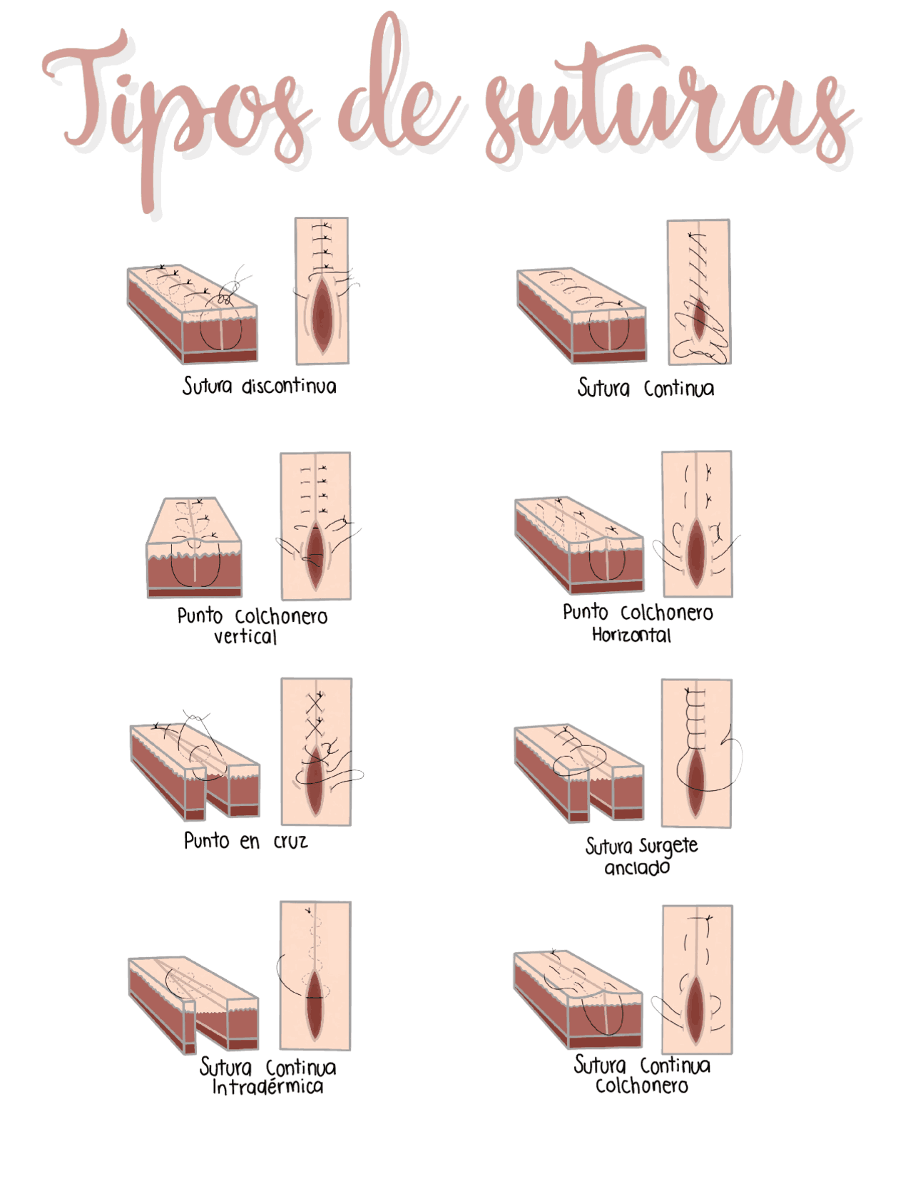 Tipos de suturas comunes | Diapositivas de Medicina | Docsity