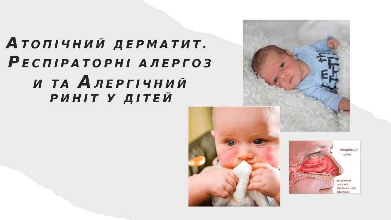 Презентація на тему атопічний дерматит Презентации Педиатрия Docsity