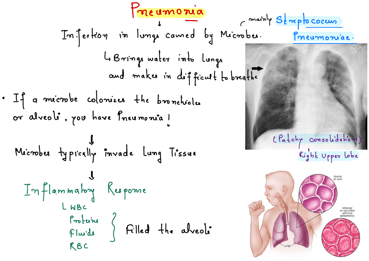 Complete Notes on Pneumonia | Study notes Nursing | Docsity