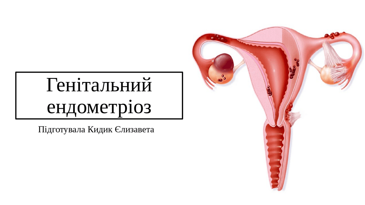 Генітальний ендометріоз презентація Презентации Акушерство и