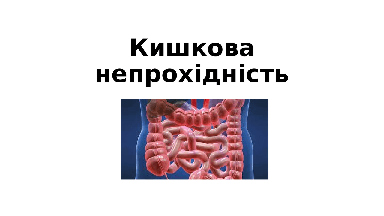 гостра кишкова непрохідність презентація Презентации Хирургия Docsity