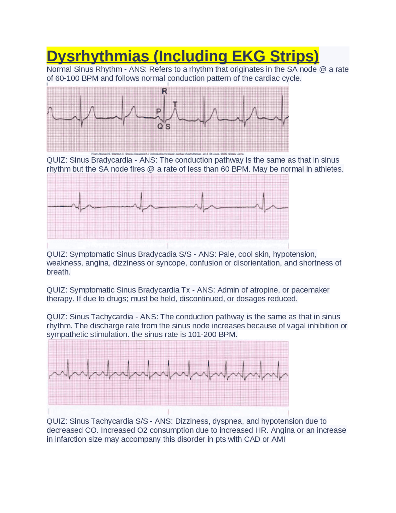 Dysrhythmias (Including EKG Strips) | Exams Nursing | Docsity