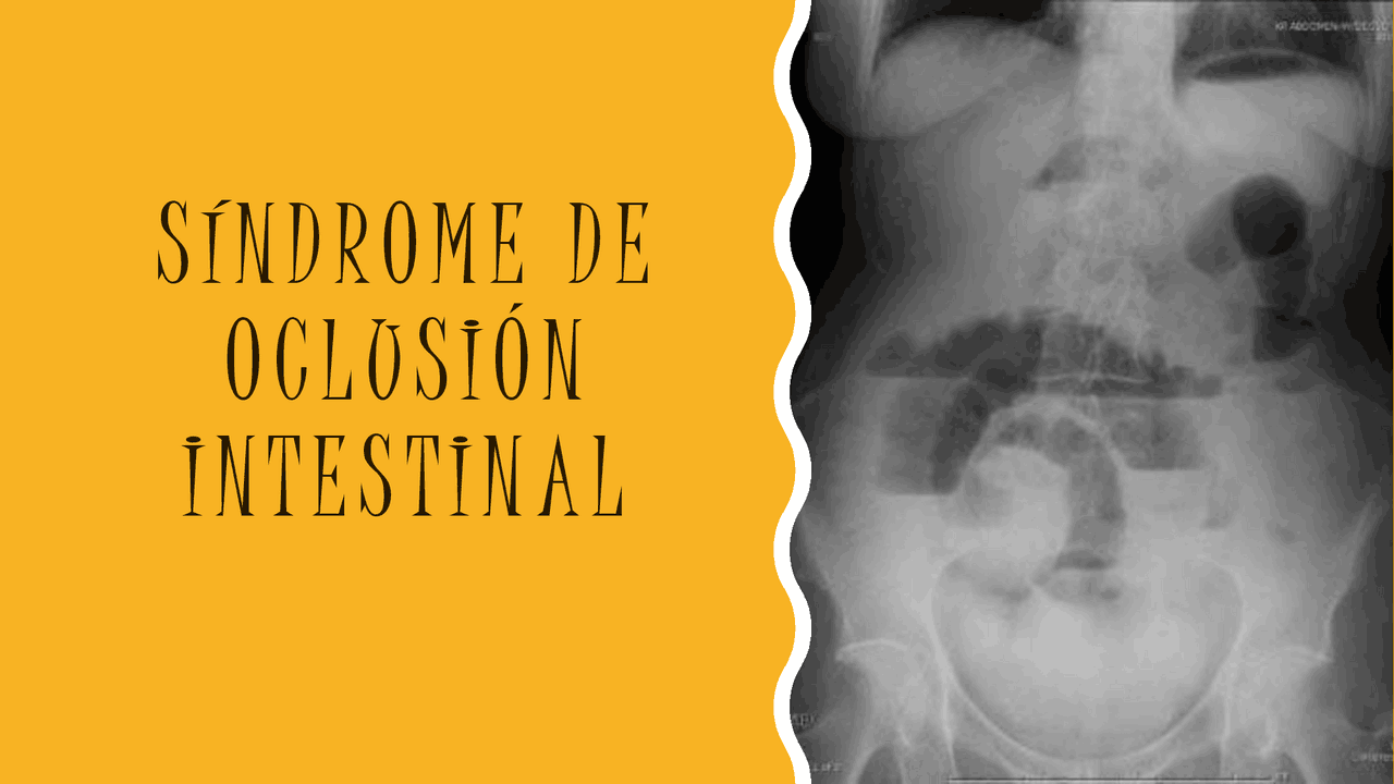 SÍNDROME DE OCLUSION INTESTINAL | Diapositivas de Gastroenterología ...