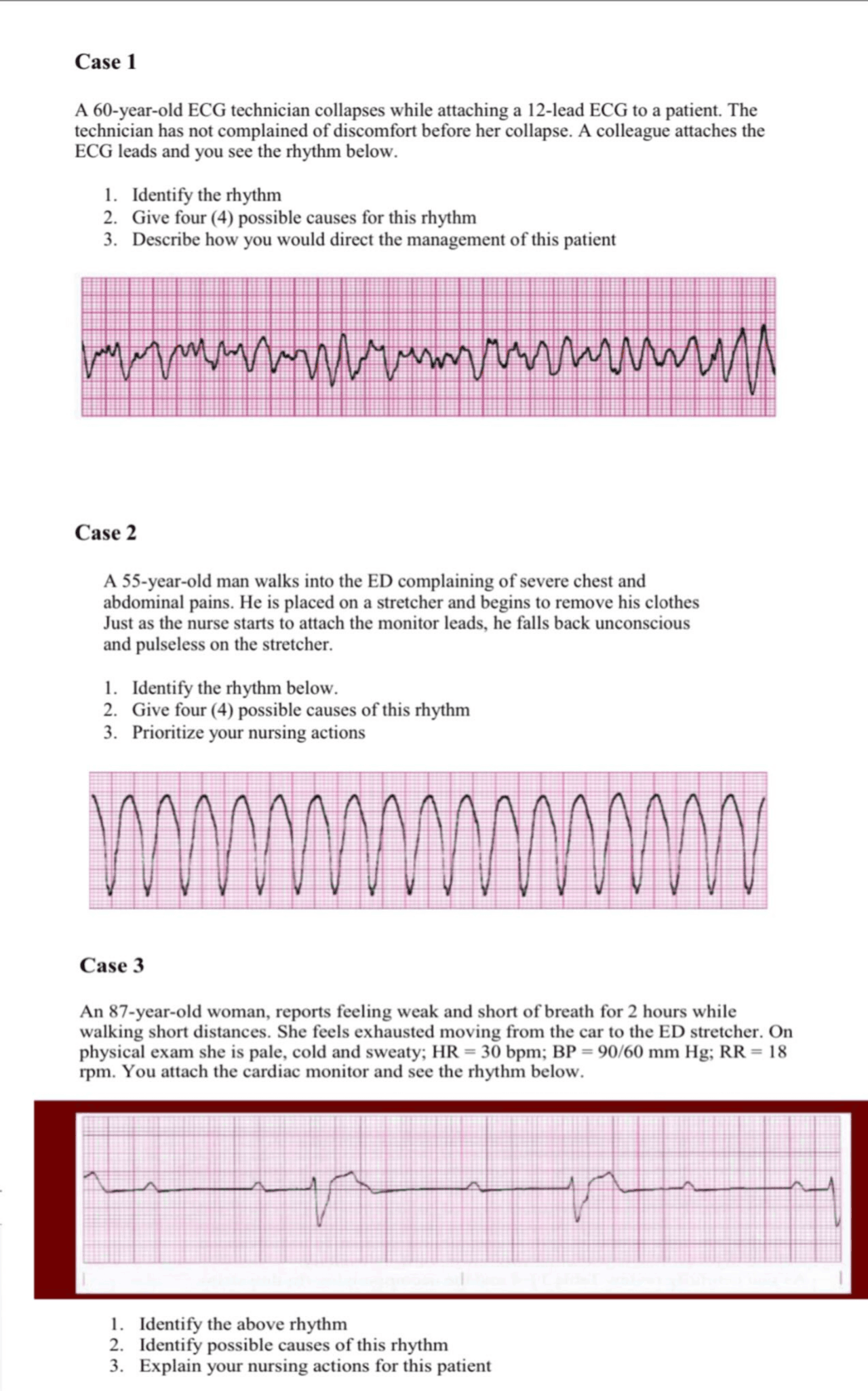 ECG CASES MOST COMMON | Study notes Nursing | Docsity