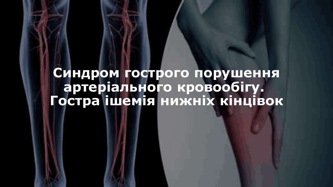 Презентація Гостра ішемія нижніх кінцівок Конспекты лекций