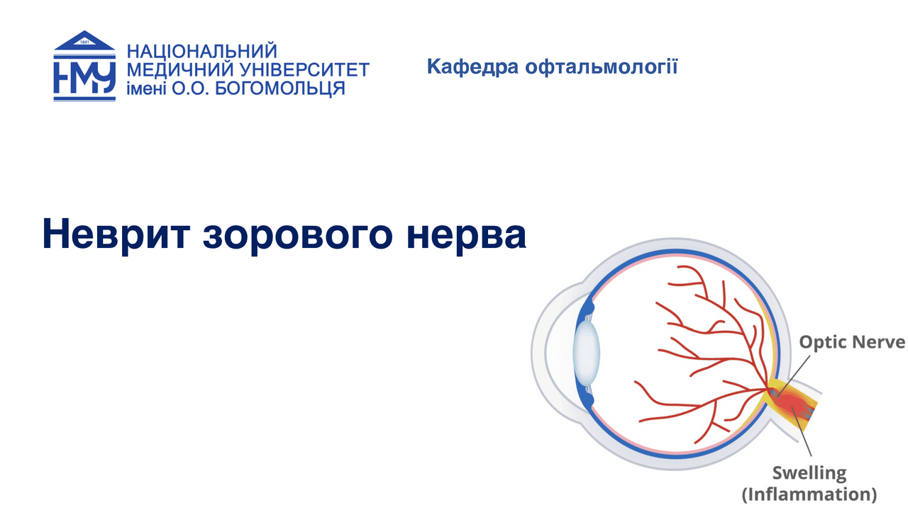 Презентація Неврит зорового нерва Презентации Офтальмология Docsity