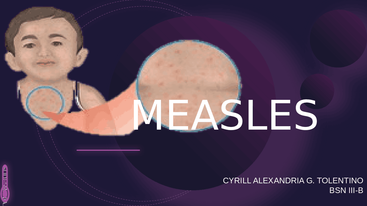 Measles: Understanding the Highly Contagious Viral Disease | Cheat Sheet Preventive medicine ...