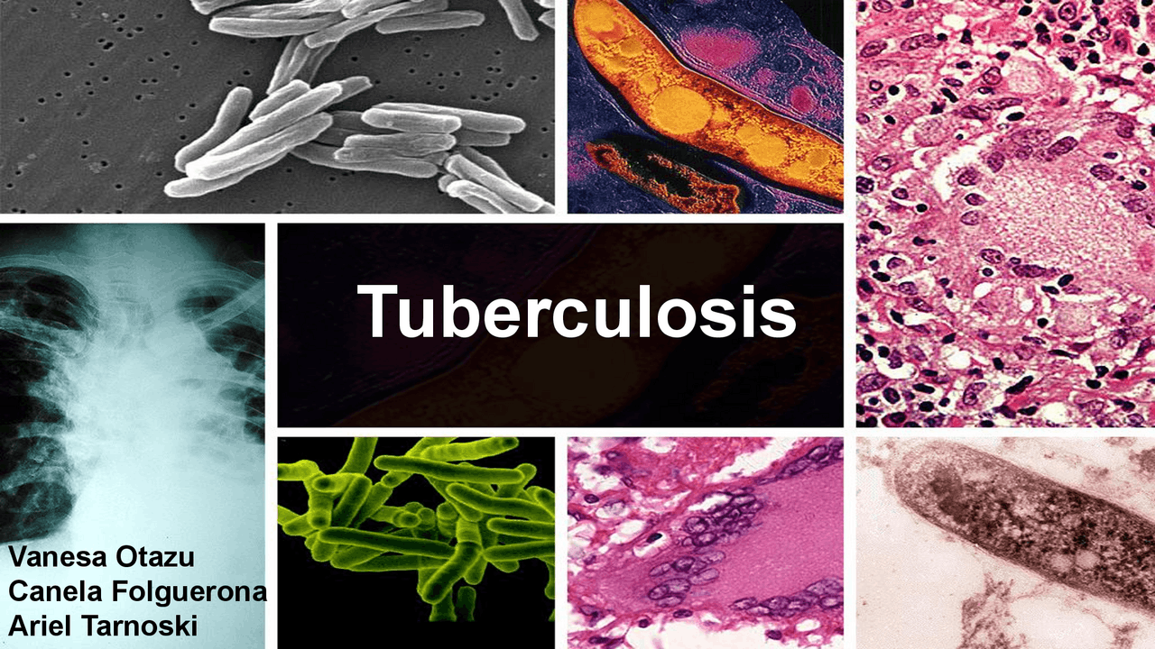 La tuberculosis es una enfermedad infecciosa | Esquemas y mapas ...