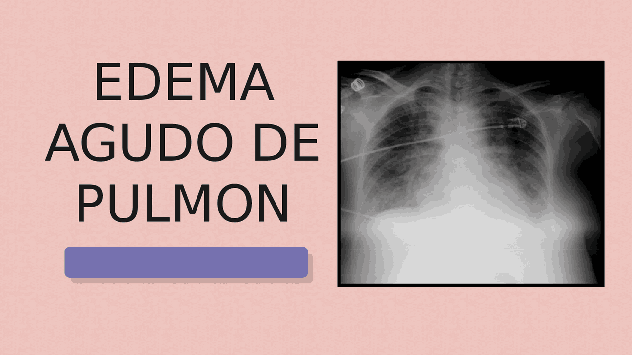 Edema Pulmonar Cardiogénico Rayos X