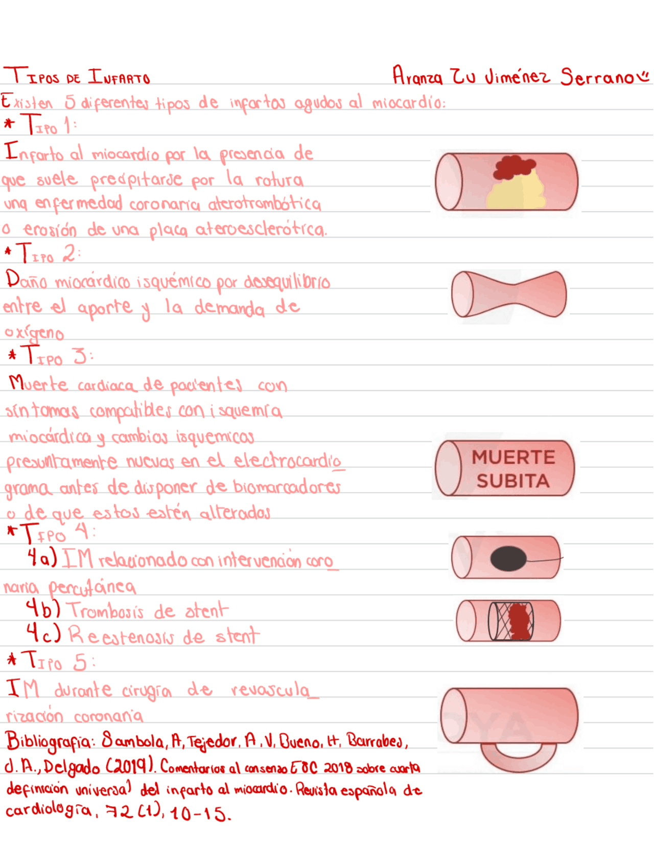 Infartos: Tipos de infartos | Resúmenes de Cardiología | Docsity