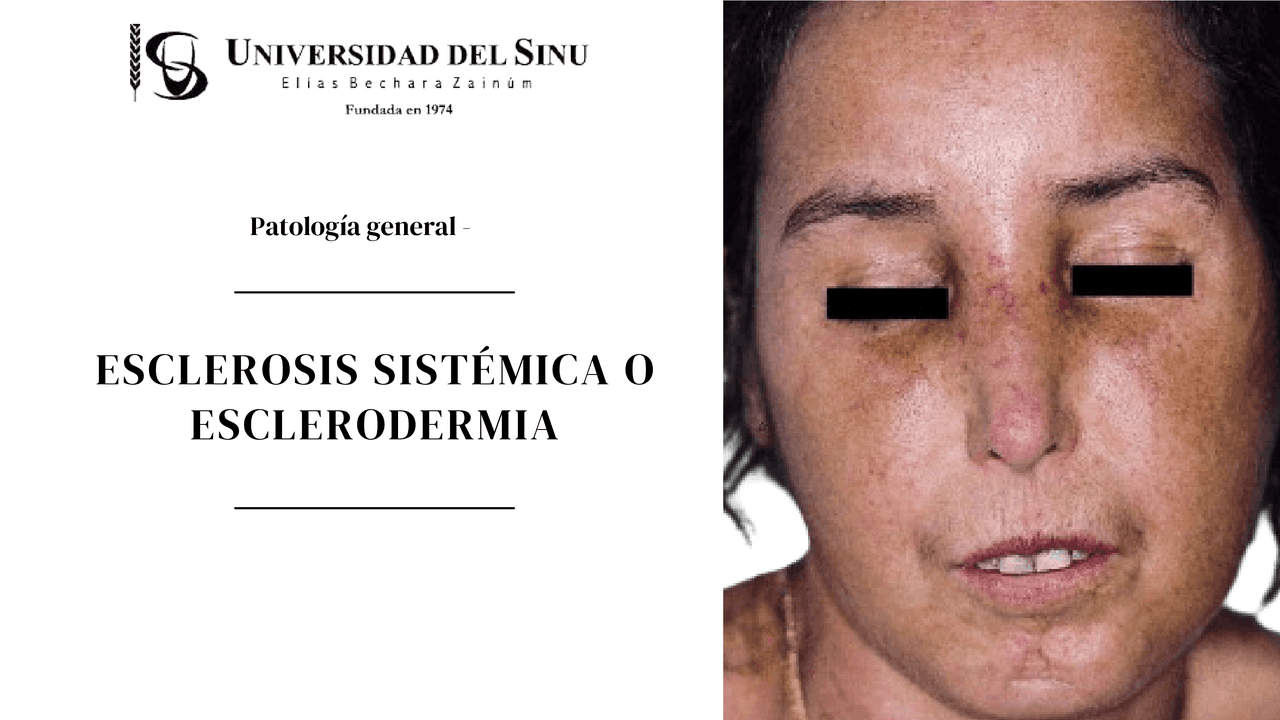 Esclerosis sistémica o esclerodermia | Diapositivas de Patología | Docsity