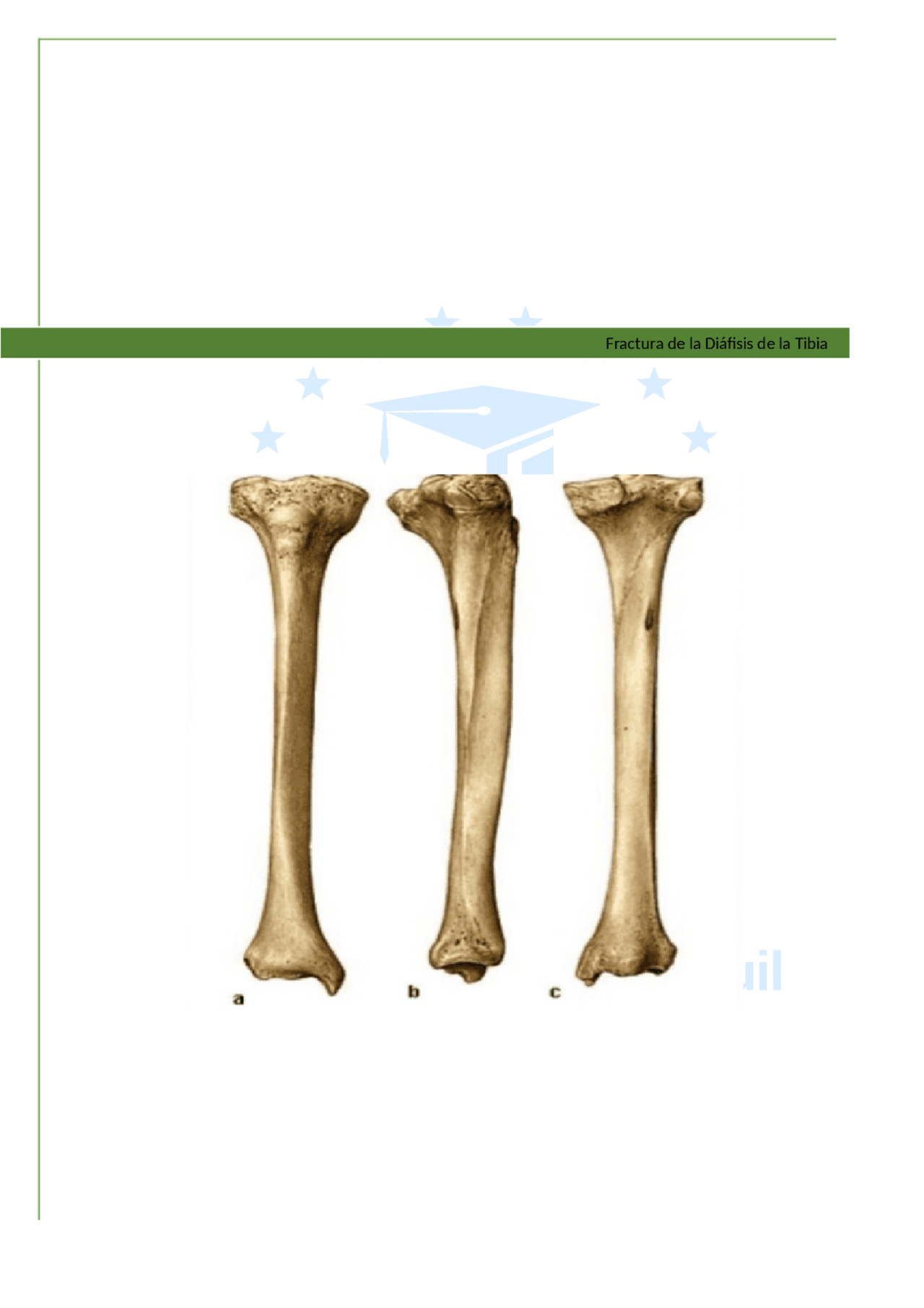 Fractura de la Diáfisis de la Tibia | Apuntes de Traumatología | Docsity