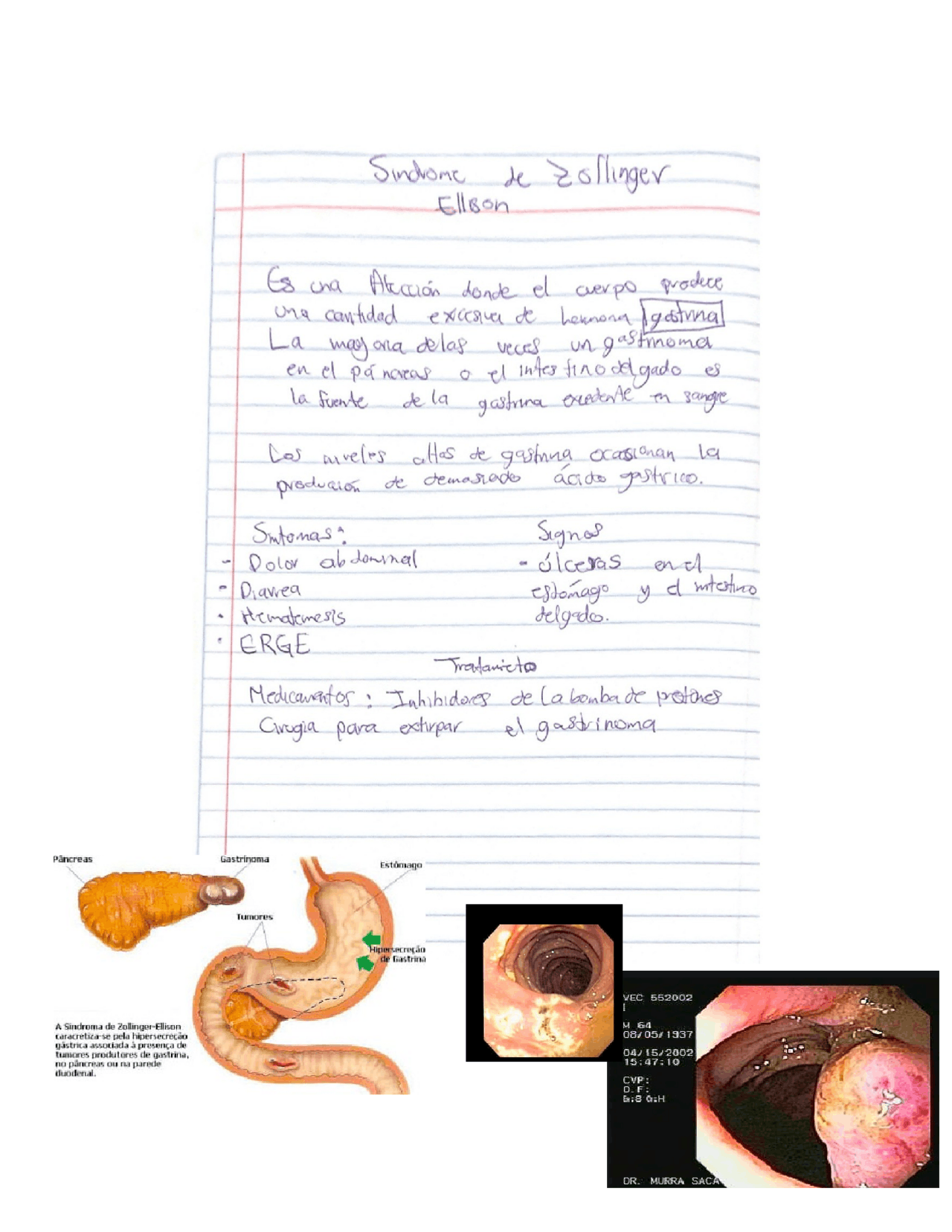 SINDROME DE ZOLLINGER ELLISON | Resúmenes de Clínica Medica | Docsity