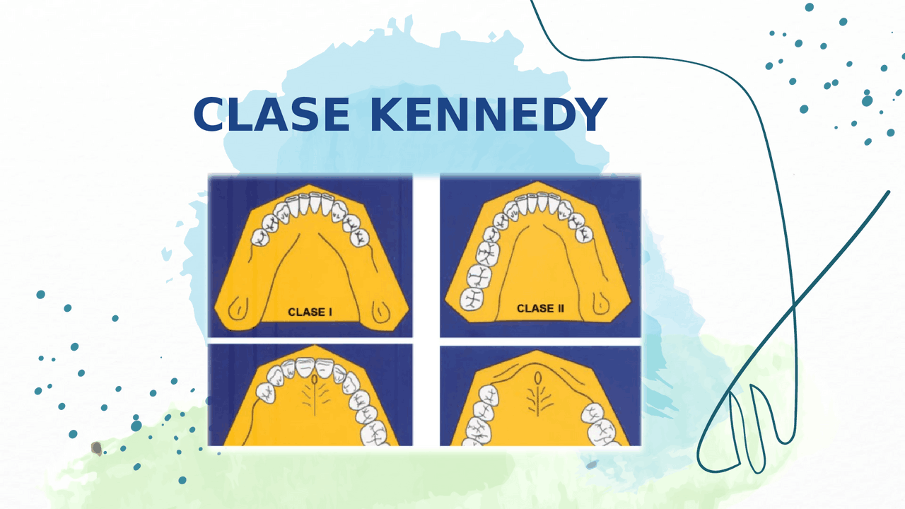 clasificacion de kennedy | Diapositivas de Odontología | Docsity
