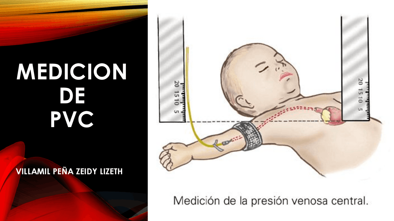 Medición de la Presión Venosa Central (PVC) | Apuntes de Enfermería ...