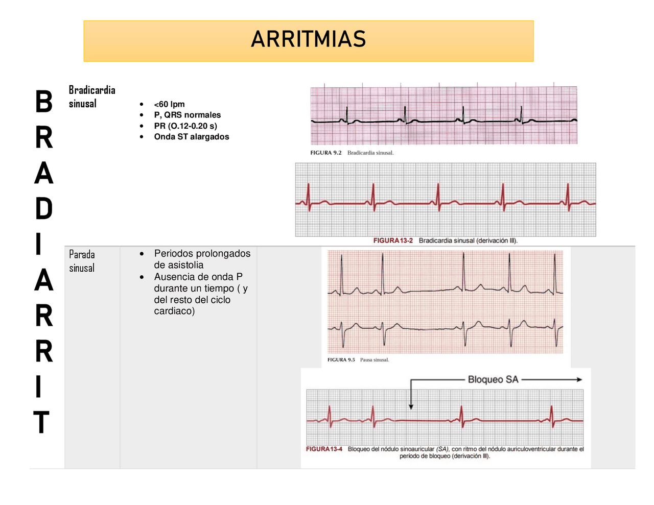 Arritmias cardíacas: Clasificación y características electrocardiográficas | Esquemas y mapas ...