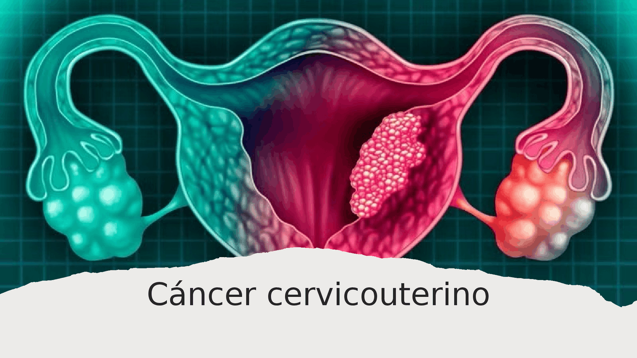 Cancer cervicouterino | Diapositivas de Oncología | Docsity
