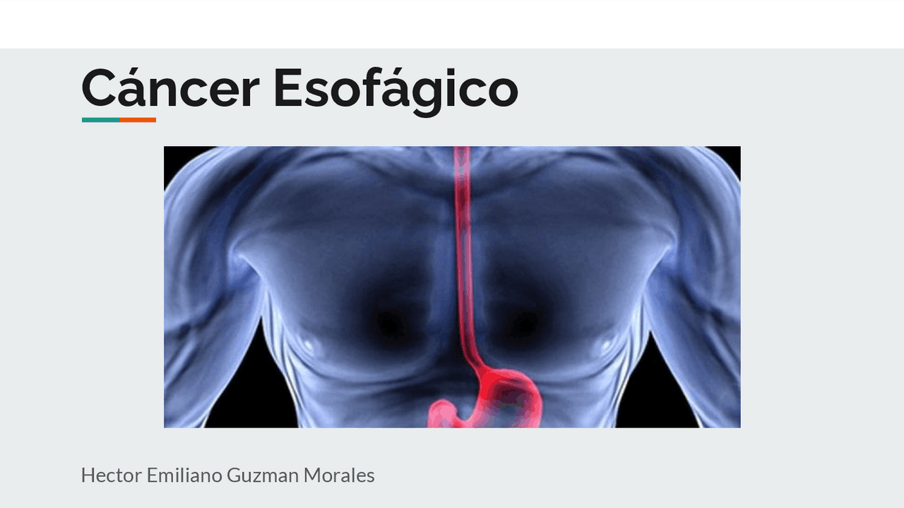 Cáncer Esofágico: Adenocarcinoma y Carcinoma Epidermoide - Prof. Villa ...
