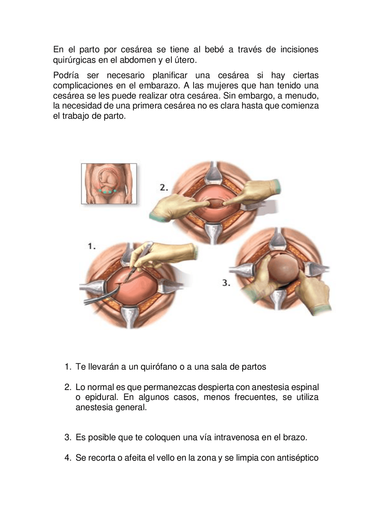Parto por cesárea pasó por paso | Diapositivas de Ginecología | Docsity