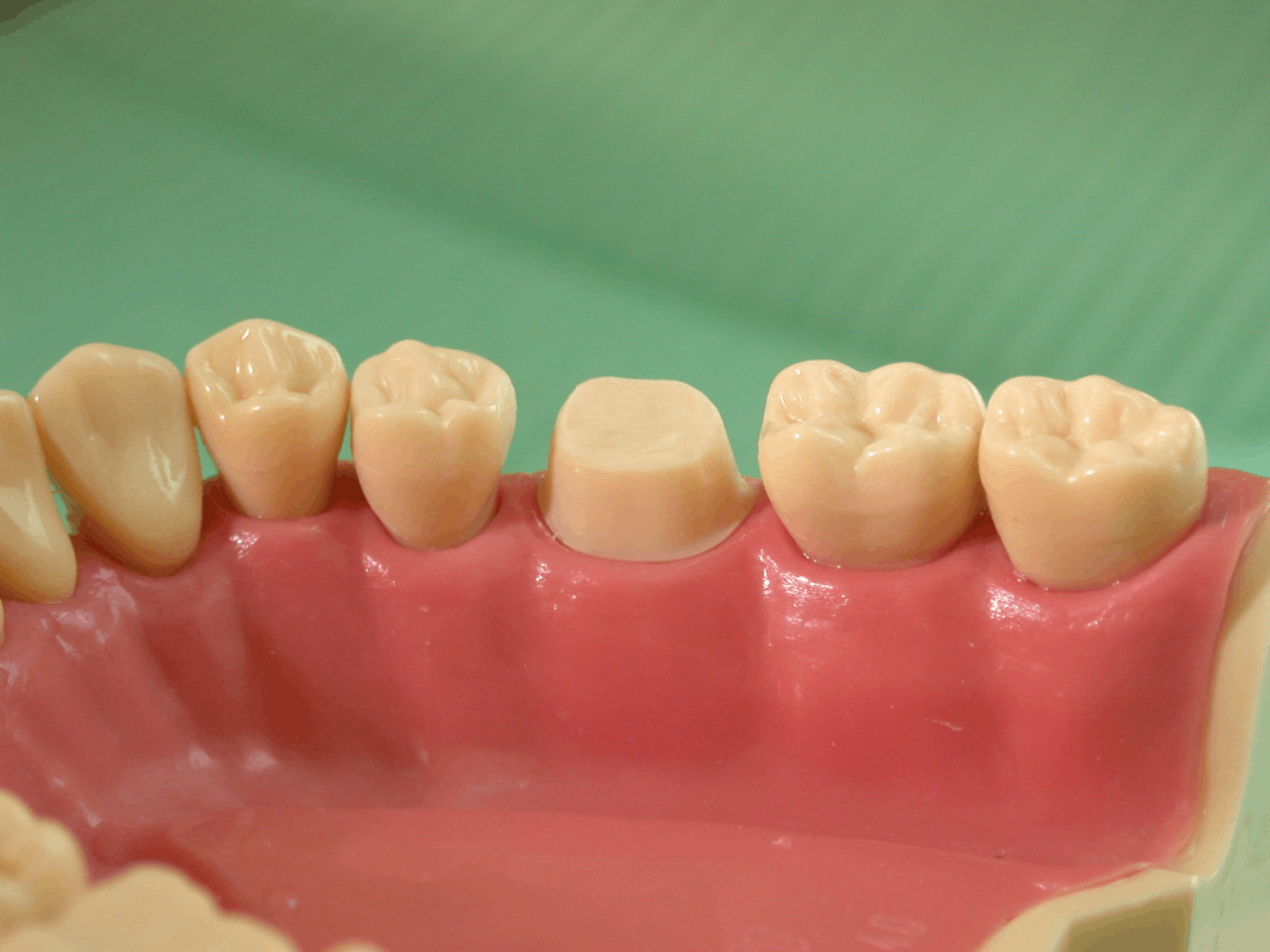 Foto Vista lingual del tallado - Apuntes de Odontología - Docsity