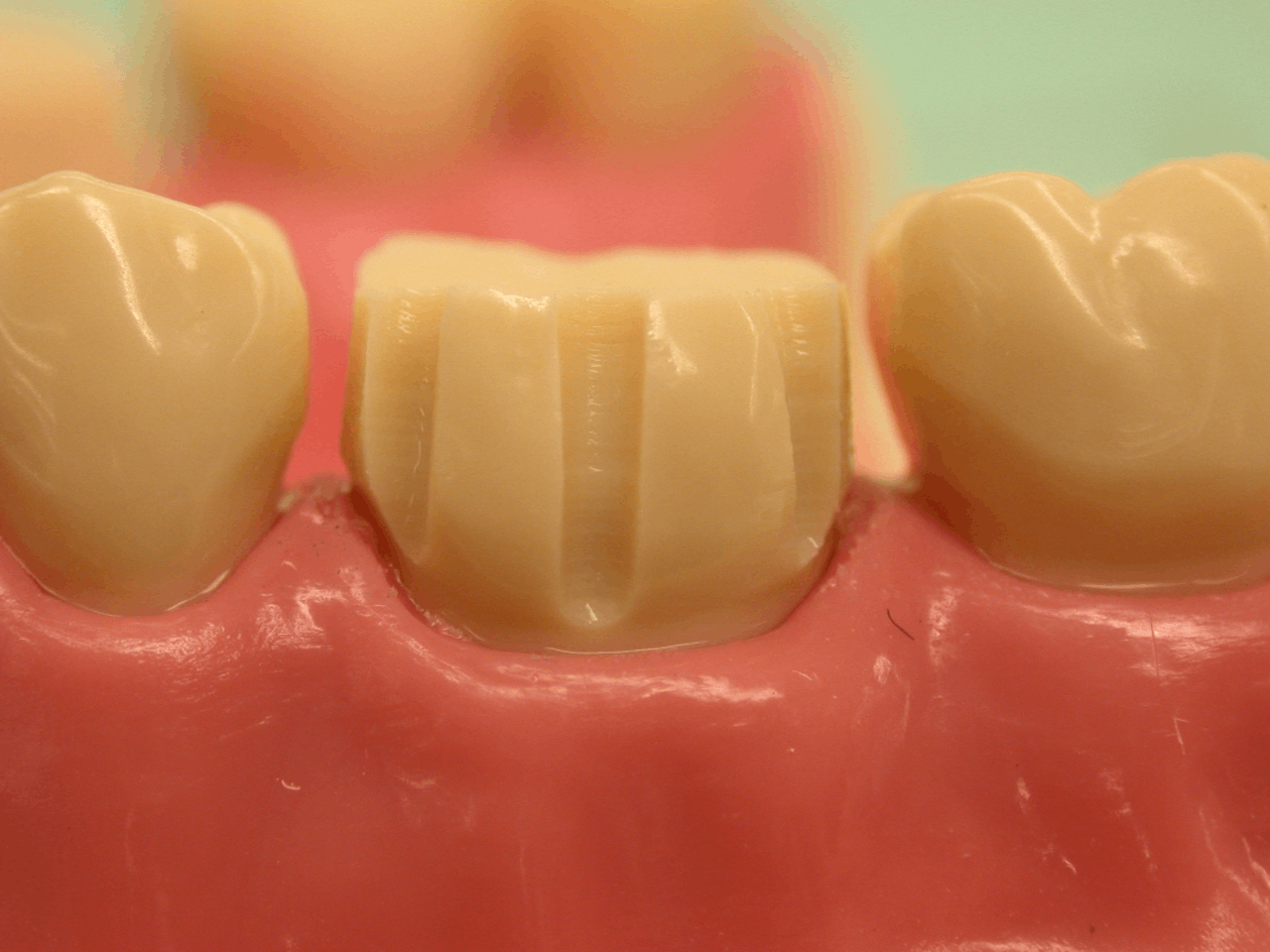 Foto de como debe quedar tallado - Apuntes de Odontología - Docsity