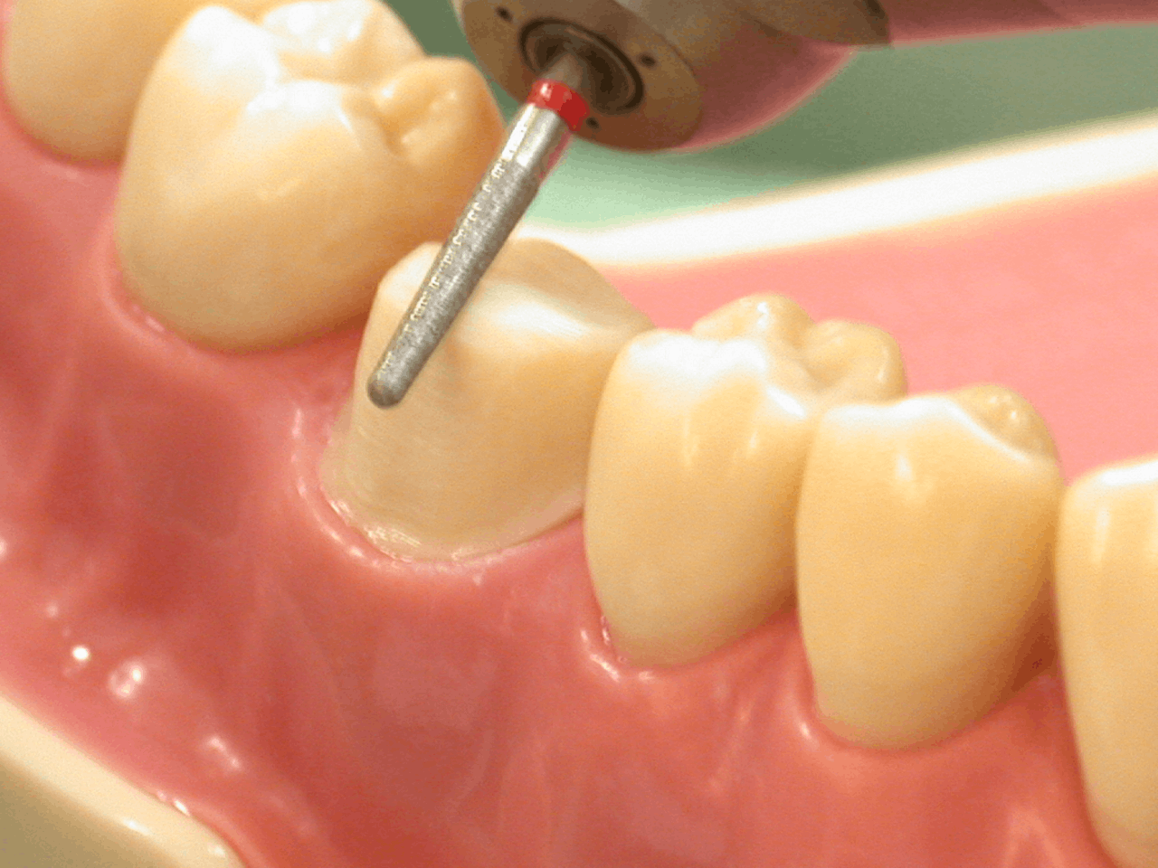 Mas fotos de tallado - Apuntes de Odontología - Docsity