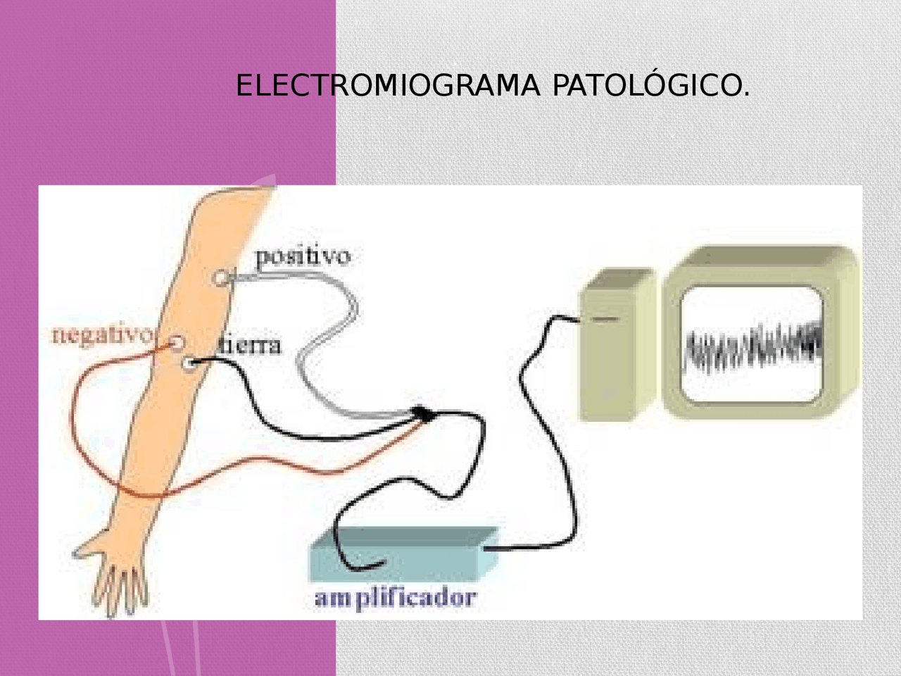 Electromiograma - Apuntes de Biofísica - Docsity