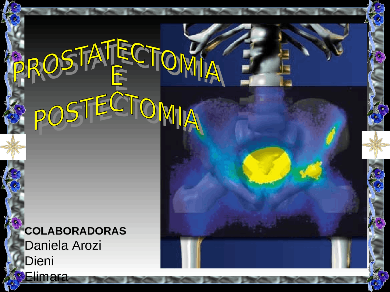 Prostatectomia e Postatectomia - Estarei relatando o que é, principais ...