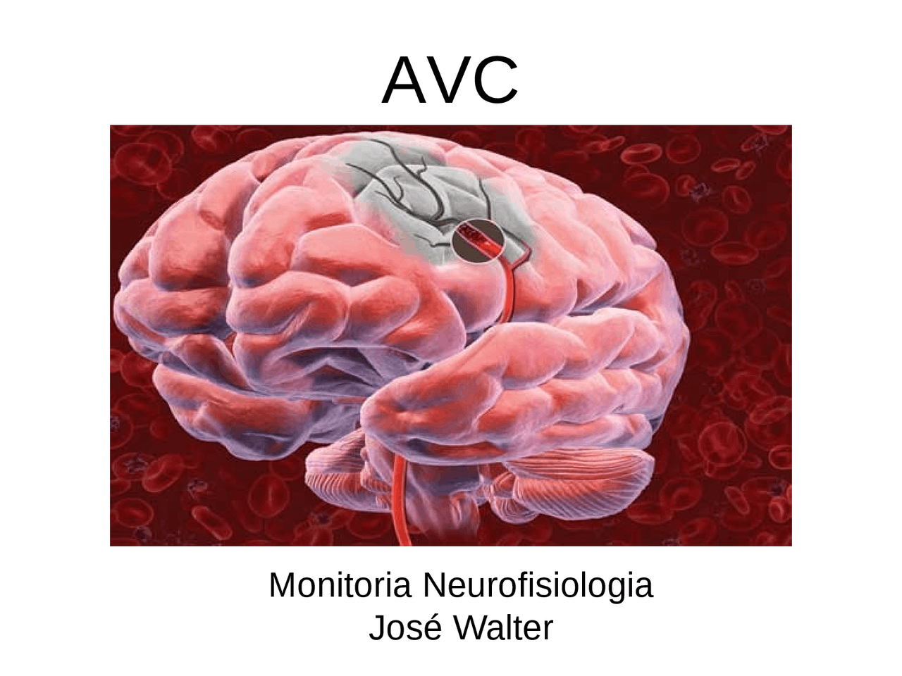 Avc (acidente vascular cerebral) - acidente vascular cerebral - Docsity