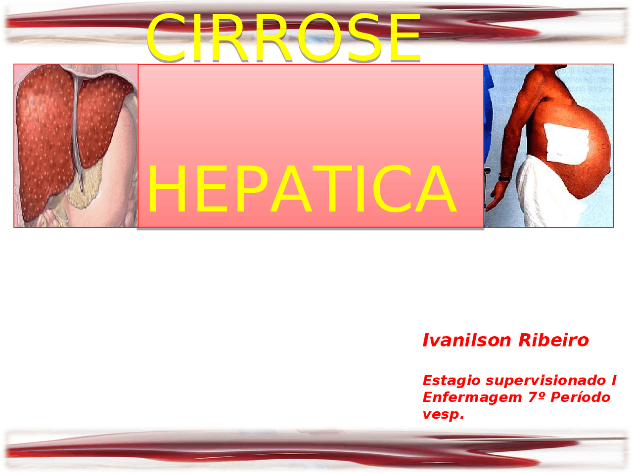 CIRROSE HEPATICA Conceito - CIRROSE - CIRROSE - Docsity