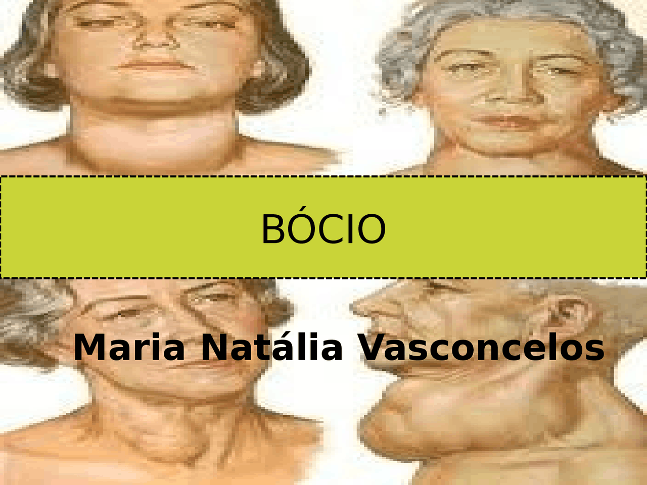 Slide do bocio - Slide sobre bócio | Docsity