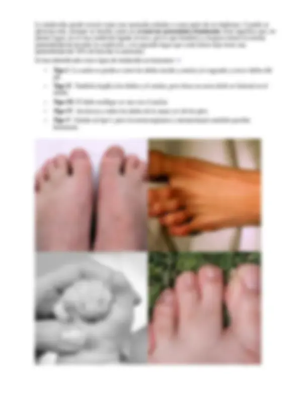 Braquidactilia, Polidactilia y Ectrodactilia: Defectos Congénitos de ...