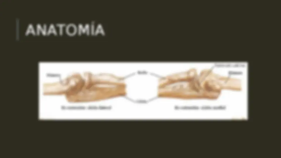 Fracturas de humero 4 | Diapositivas de Ortopedía | Docsity