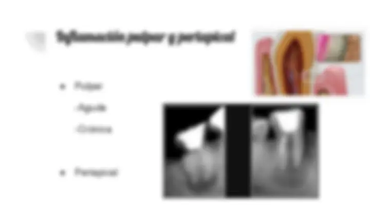 Diagnostico de caries, lesiones pulpares y periodontales. | Diapositivas de Endodoncia | Docsity