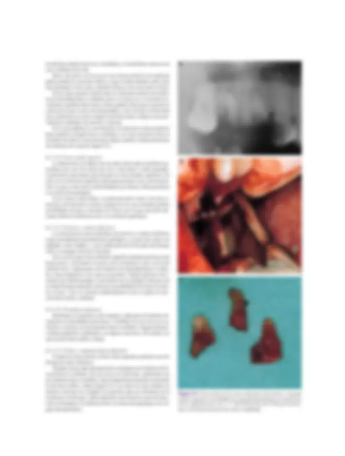 Extracción de Restos Radiculares: Técnicas y Procedimientos en ...