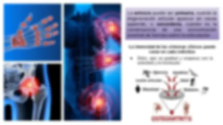 Fisiopatología y Manejo del Dolor en la Artrosis: Un Enfoque Integral | Study Guides, Projects ...