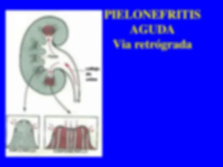 Pielonefritis: Causas, Patología y Aspectos Clínicos de la Infección ...