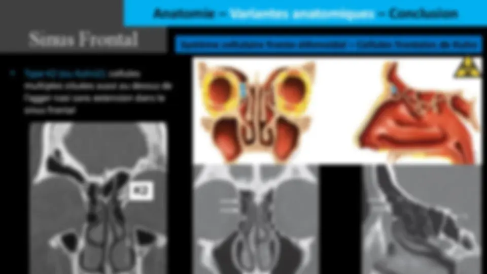 Variantes anatomiques des sinus de la face | Schémas Anatomie | Docsity